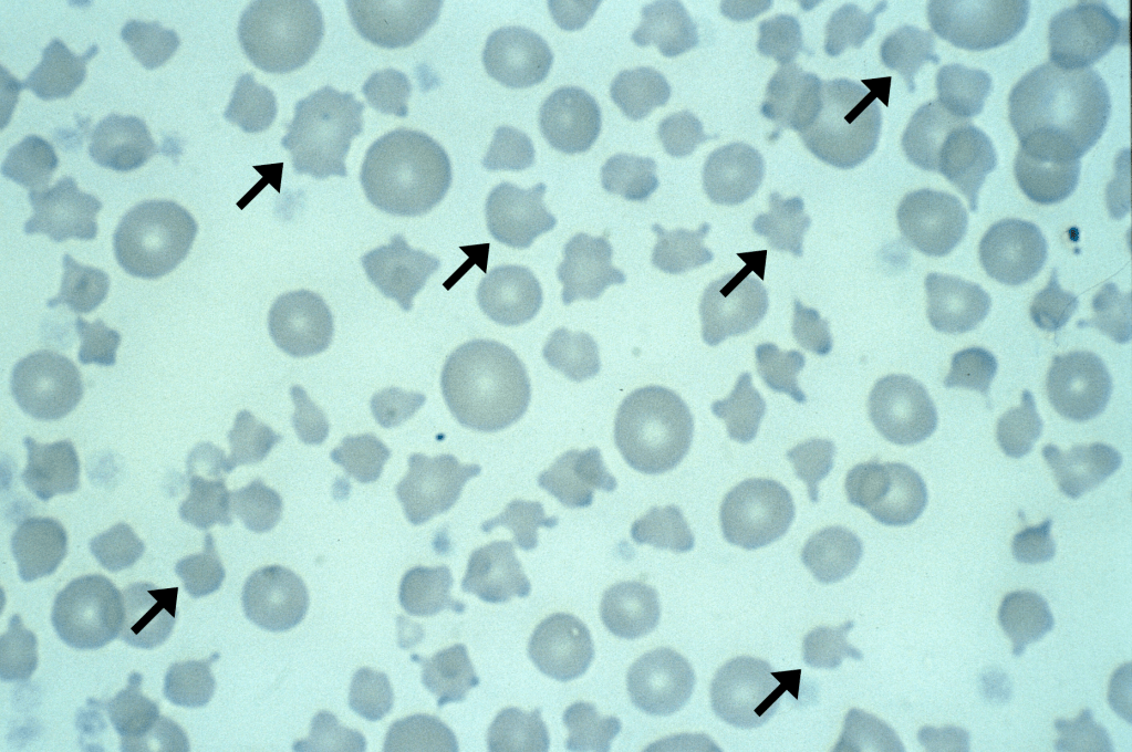 Acanthocytes – Cells and Smears