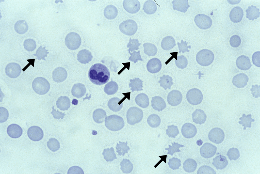 Acanthocytes – Cells and Smears