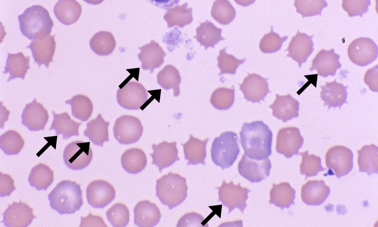 Acanthocytes – Cells and Smears