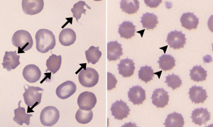 Acanthocytes – Cells and Smears