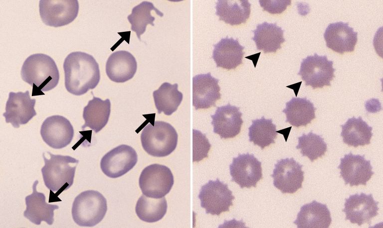 Acanthocytes – Cells and Smears
