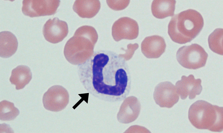 Bands (Left Shift) – Cells and Smears