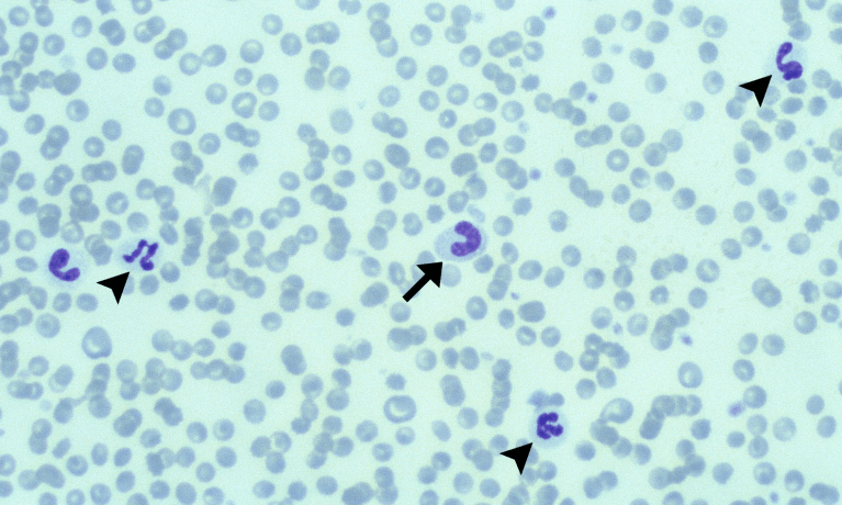 Bands (Left Shift) – Cells and Smears