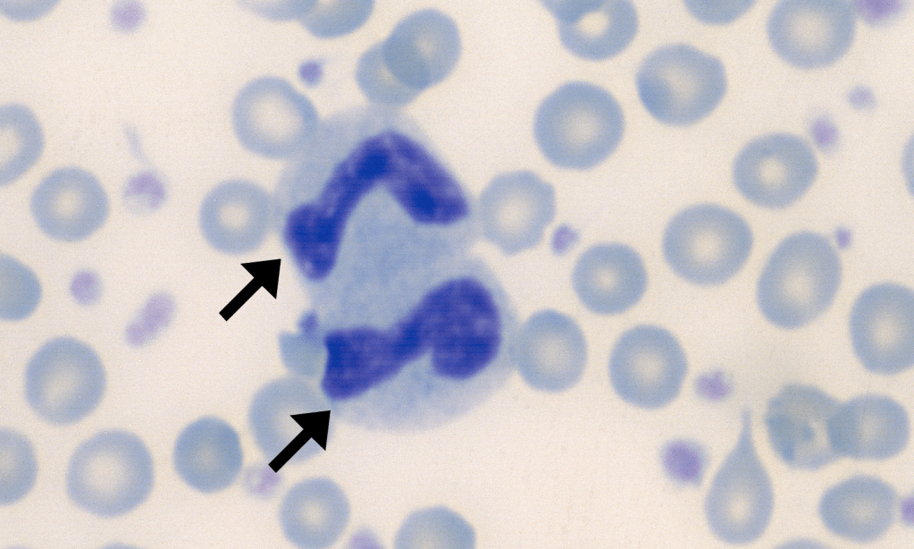 Bands (Left Shift) – Cells and Smears