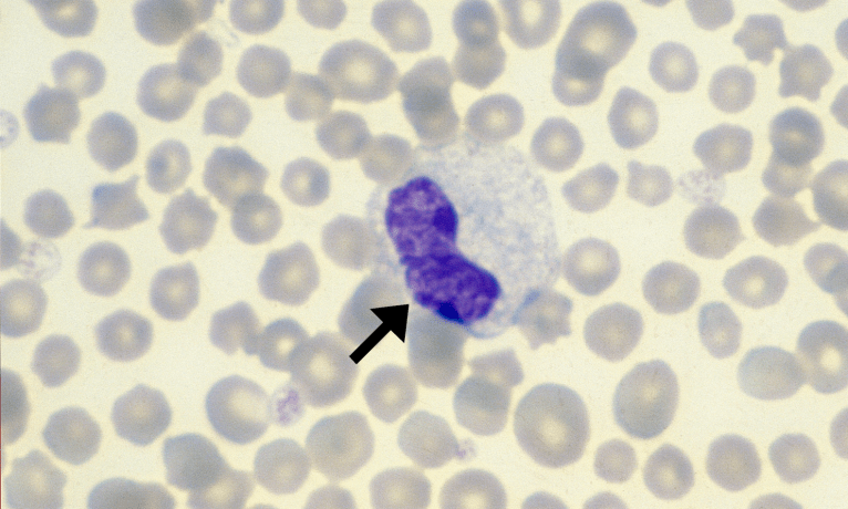 Bands (Left Shift) – Cells and Smears