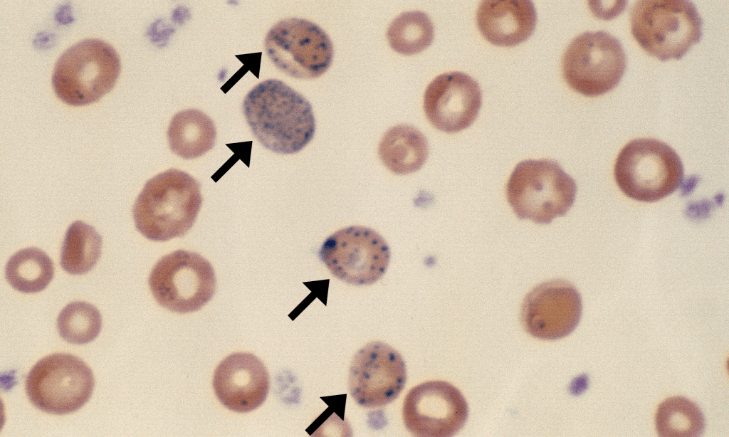 Basophilic Stippling – Cells and Smears
