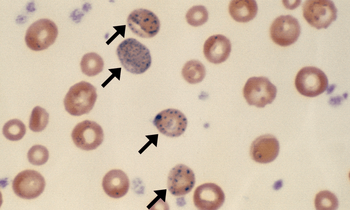 Basophilic Stippling – Cells and Smears