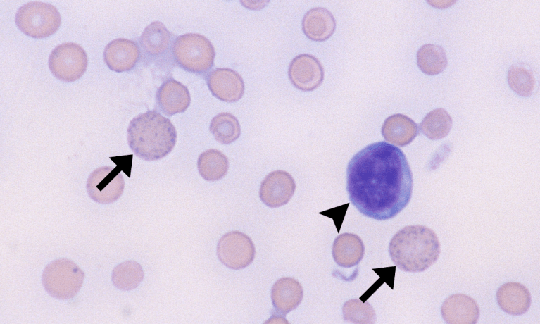 Basophilic Stippling – Cells and Smears