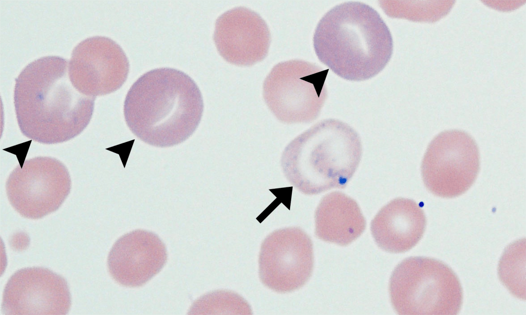 Basophilic Stippling – Cells and Smears