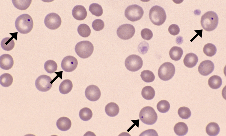 Howell-Jolly Bodies – Cells and Smears