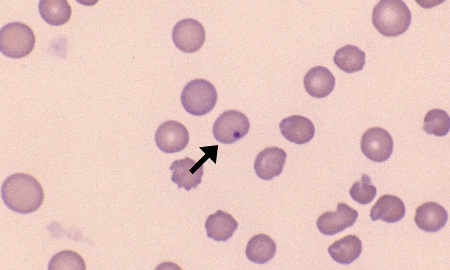 Howell-Jolly Bodies – Cells and Smears