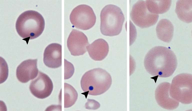 Howell-Jolly Bodies – Cells and Smears