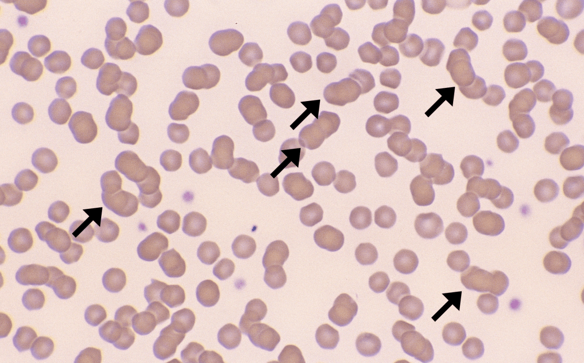 Rouleaux Cells Autoagglutination Vs Rouleaux Formation | Medical