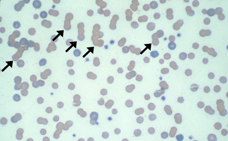 Rouleaux – Cells and Smears