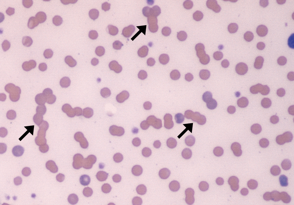 Rouleaux – Cells and Smears