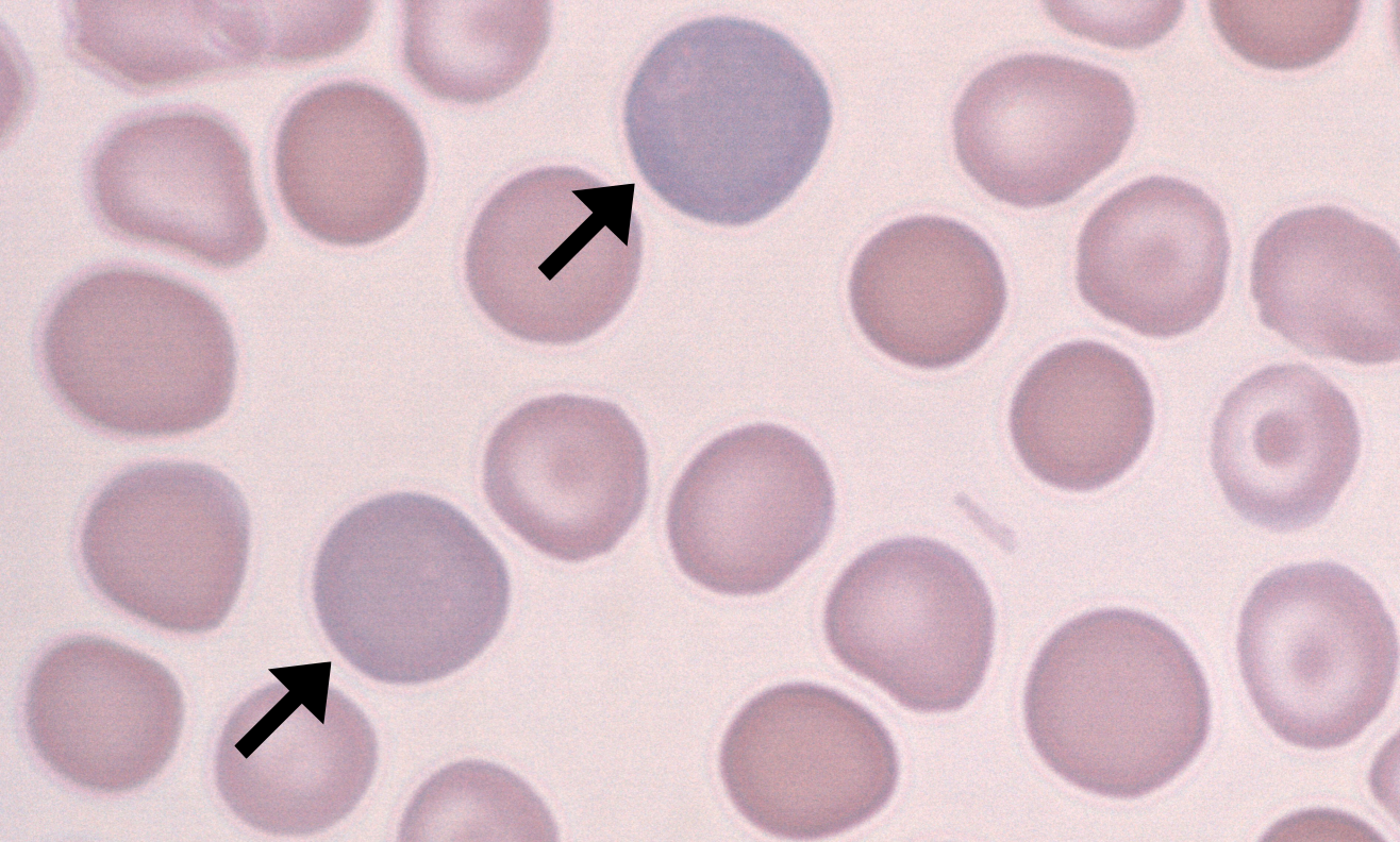 Polychromatophils – Cells and Smears