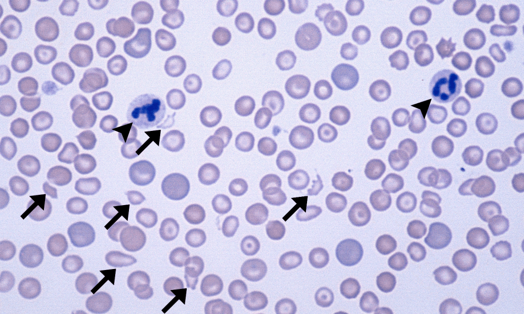 Schizocytes – Cells and Smears