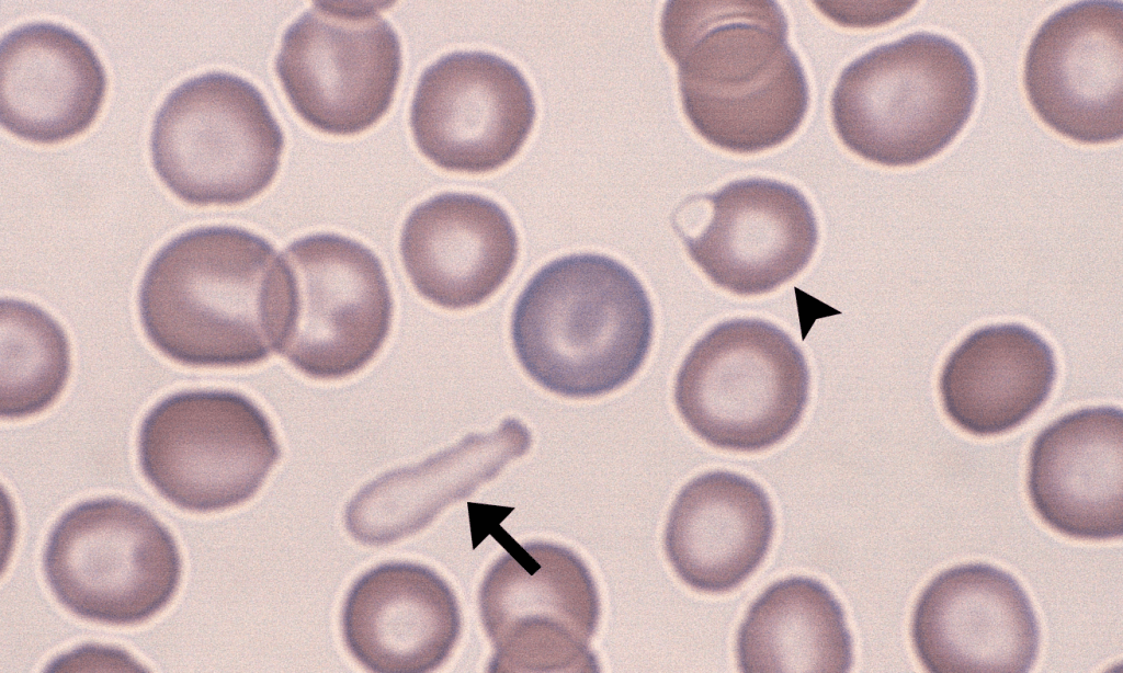Schizocytes – Cells and Smears