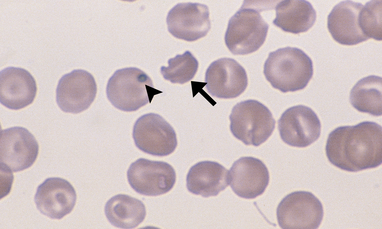 Schizocytes – Cells and Smears
