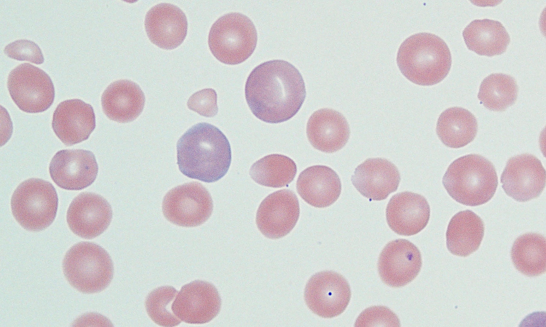 Anisocytosis – Cells and Smears