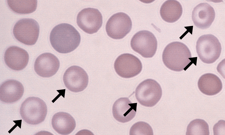 Codocytes – Cells and Smears