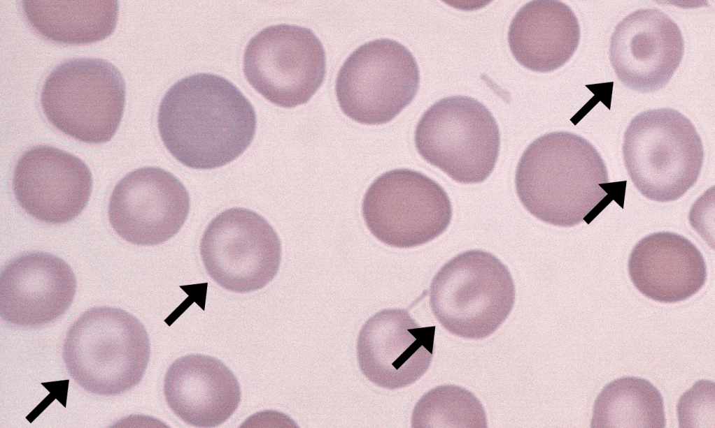 Codocytes – Cells and Smears