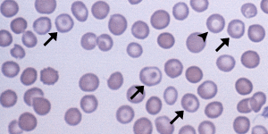 Codocytes – Cells and Smears