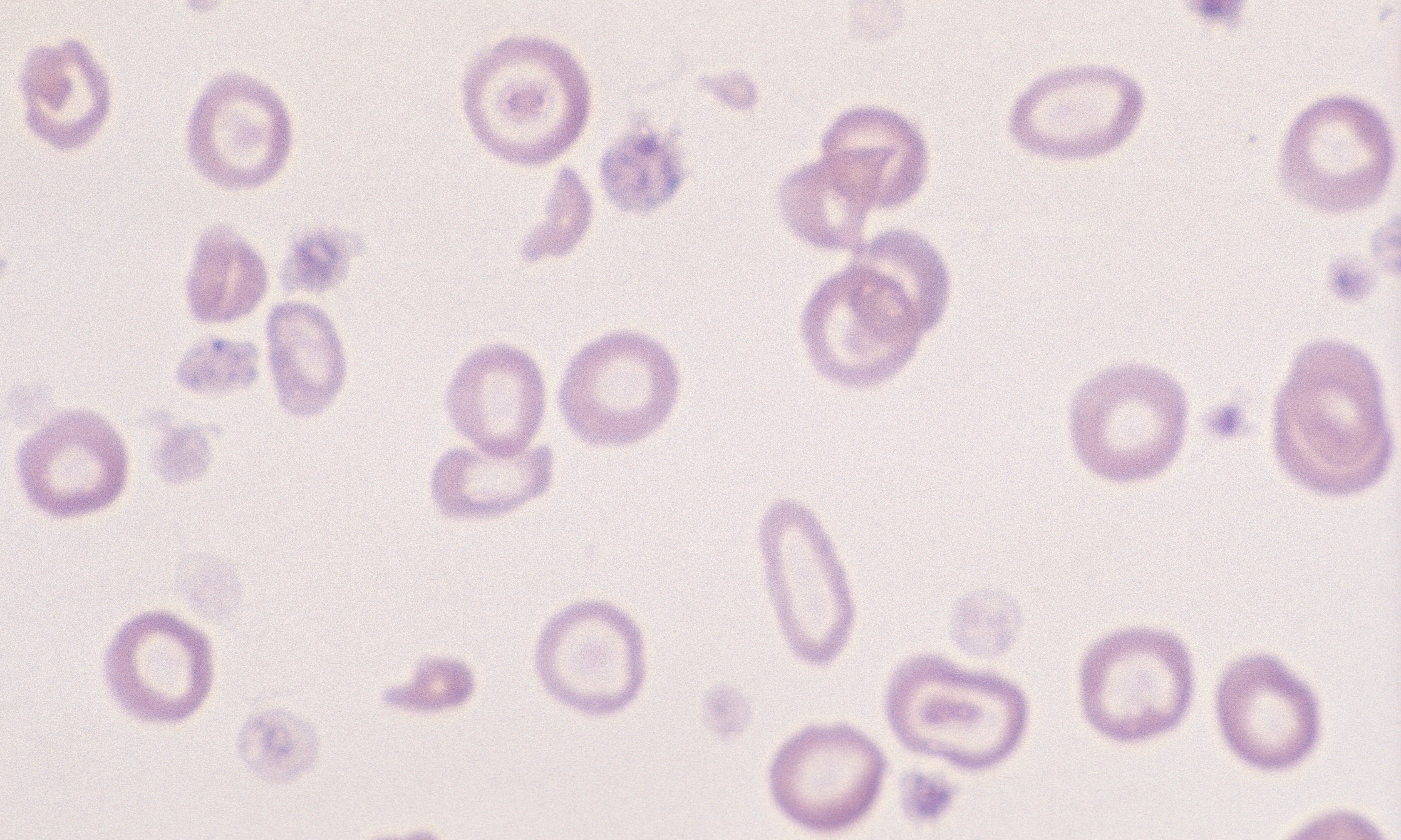 Hypochromasia – Cells and Smears