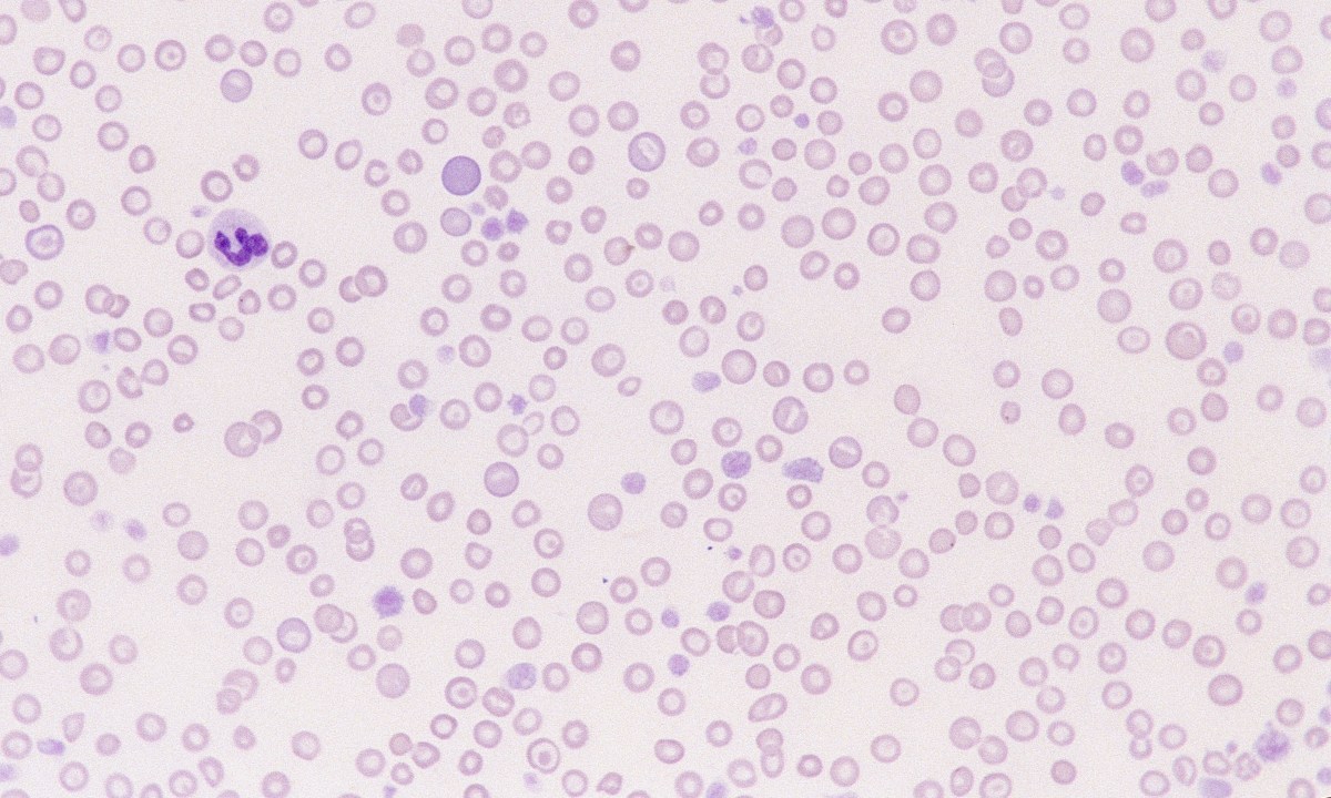 Hypochromasia – Cells and Smears