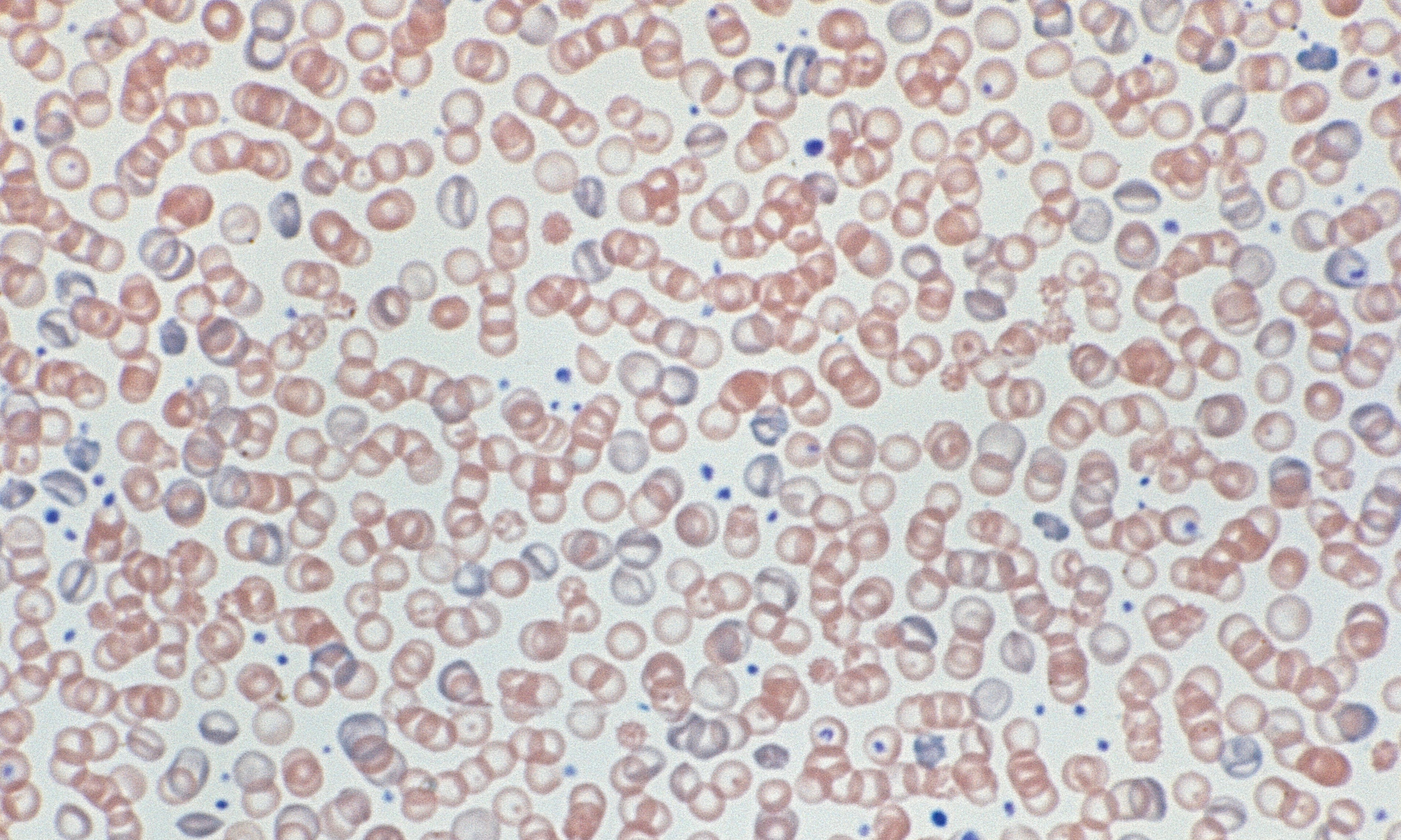 Hypochromasia – Cells and Smears