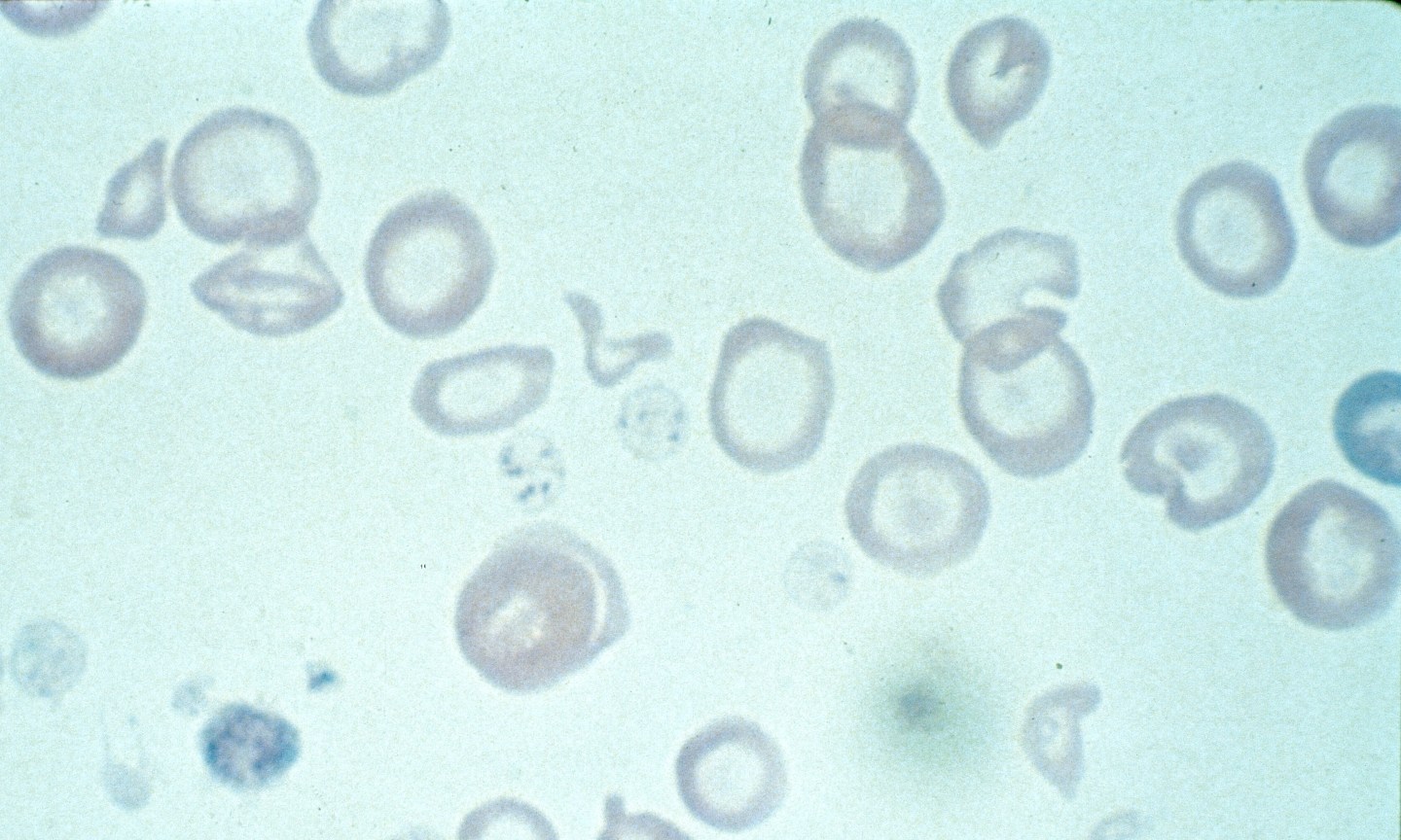 Hypochromasia – Cells and Smears