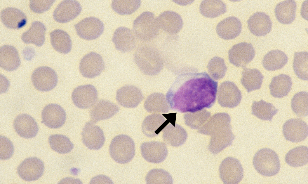 Mature Lymphocytes – Cells and Smears