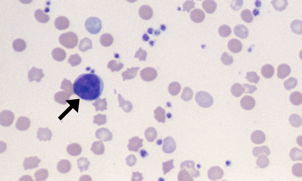 Mature Lymphocytes – Cells and Smears