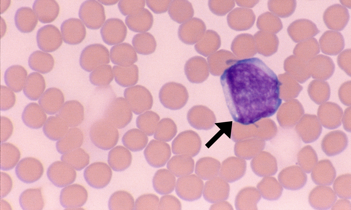 Mature Lymphocytes – Cells and Smears
