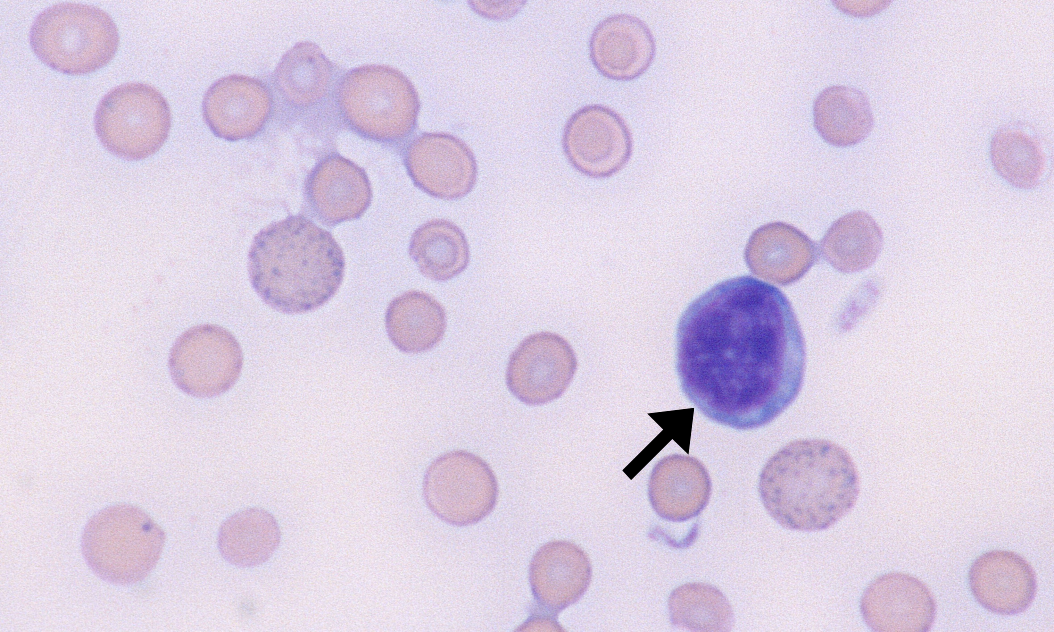 Mature Lymphocytes – Cells and Smears
