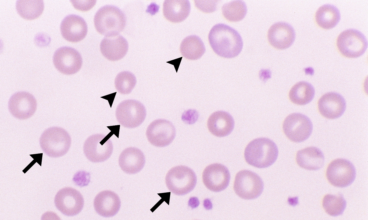 Macrocytes – Cells and Smears