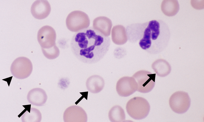 Microcytes – Cells and Smears