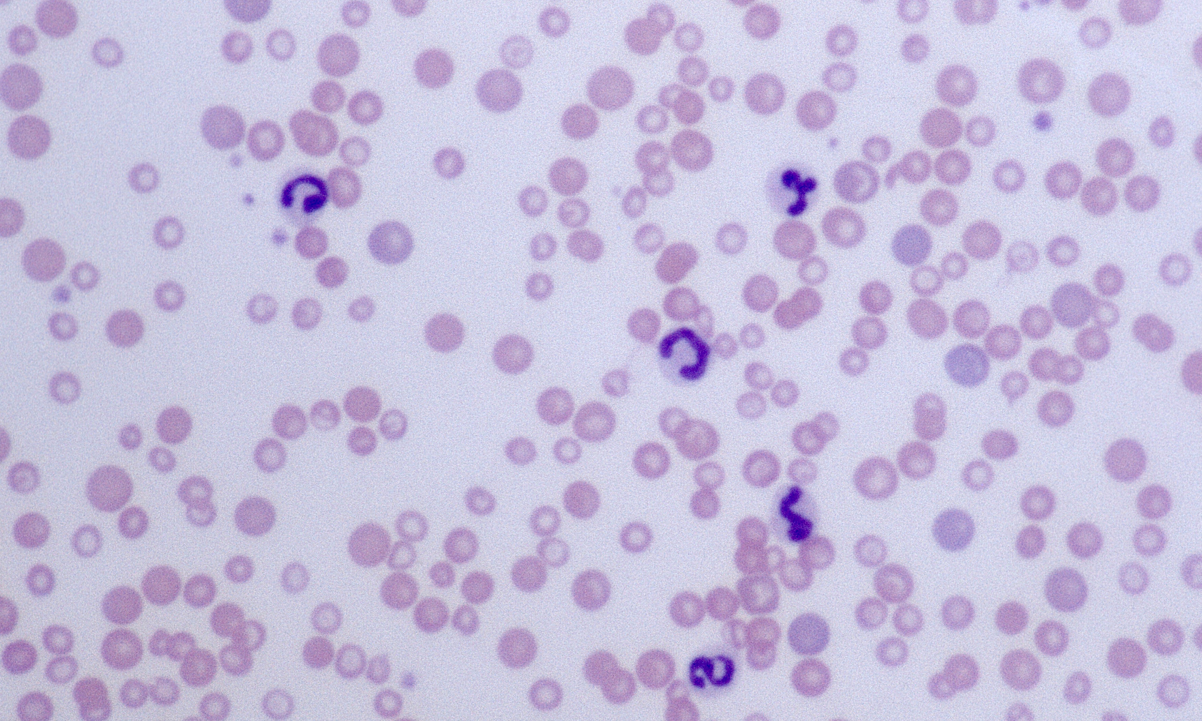 Microcytes – Cells and Smears