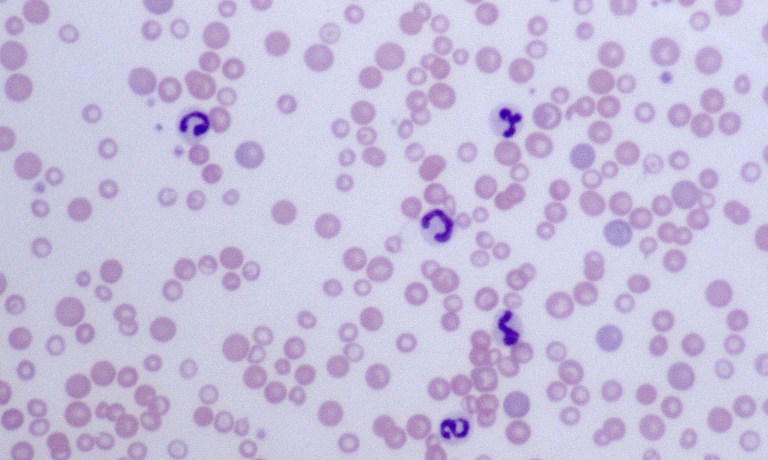 Microcytes – Cells and Smears