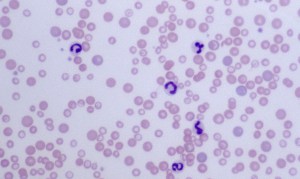 Microcytes – Cells and Smears