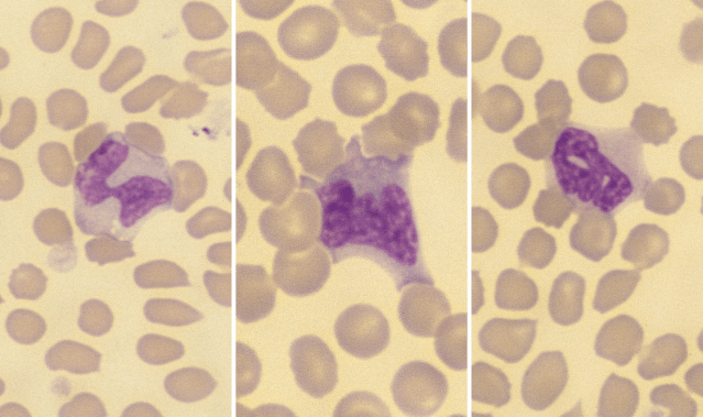 Monocytes Vs Neutrophils Neutrophil (right) And Monocyte (left) White