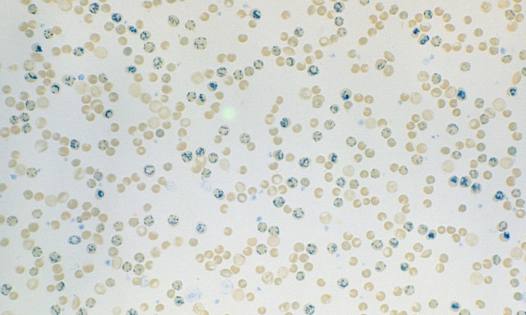 Reticulocytes – Cells and Smears