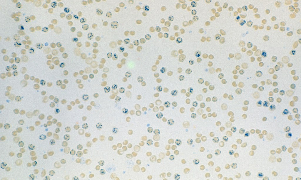 Reticulocytes – Cells and Smears