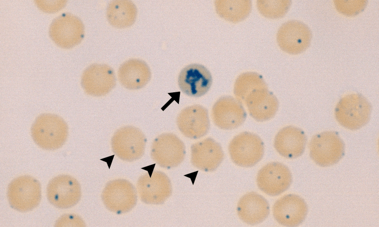 Reticulocytes – Cells and Smears