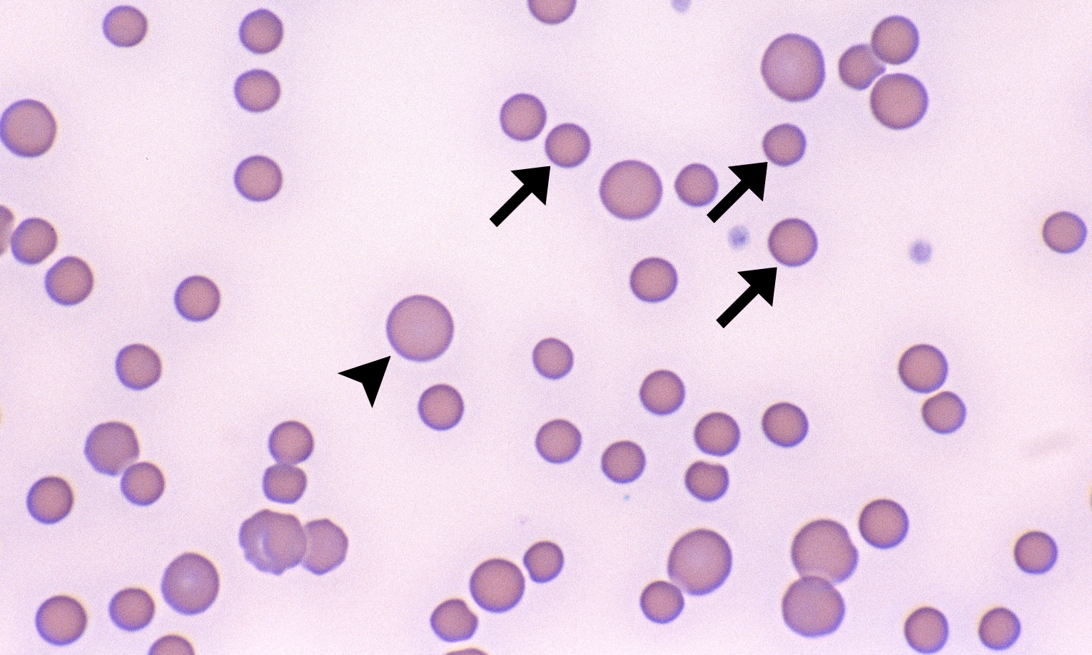 Spherocytes – Cells and Smears