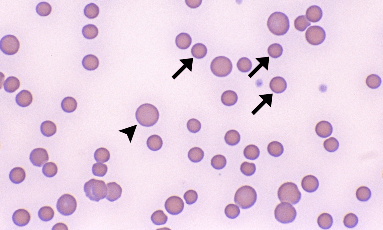 Spherocytes – Cells and Smears