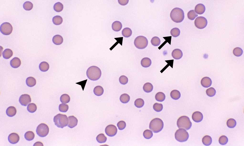 Spherocytes – Cells and Smears