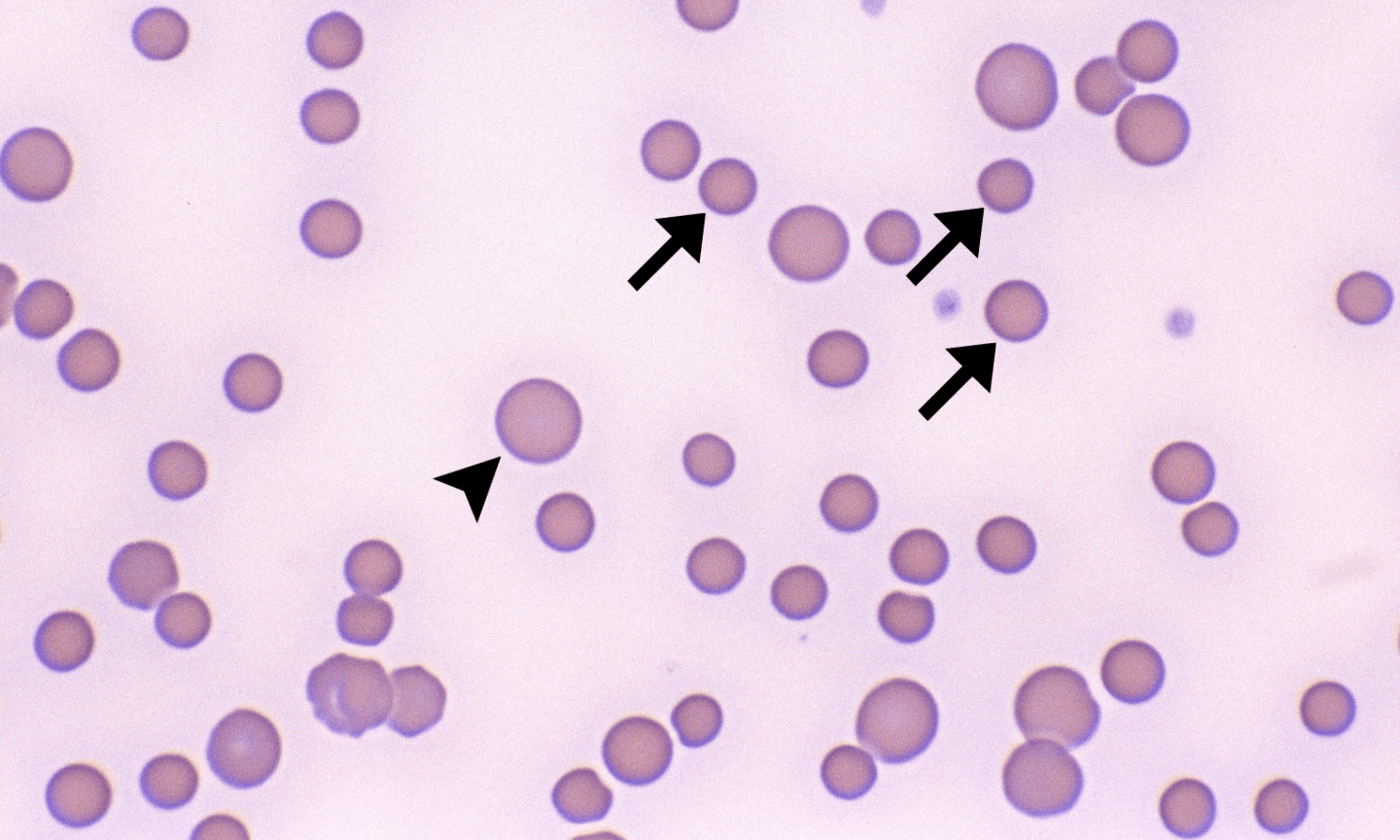 Spherocytes – Cells and Smears