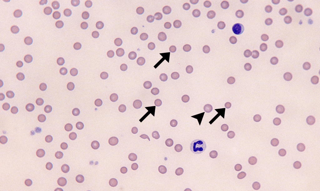 Spherocytes – Cells and Smears
