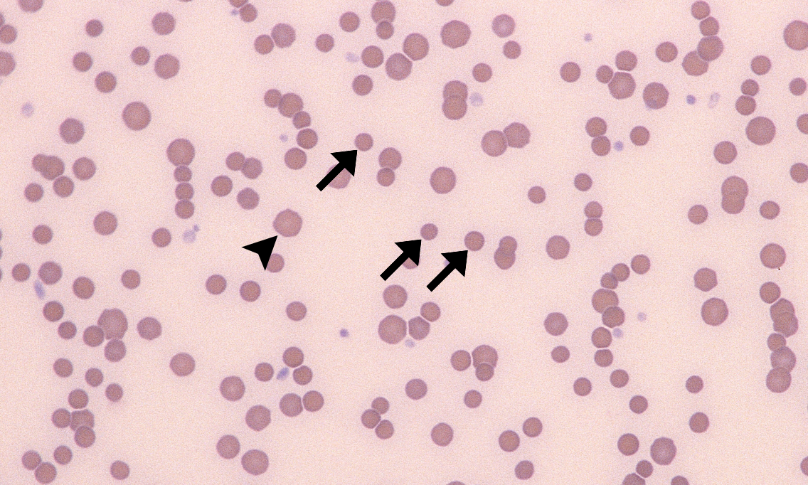 Spherocytes – Cells and Smears